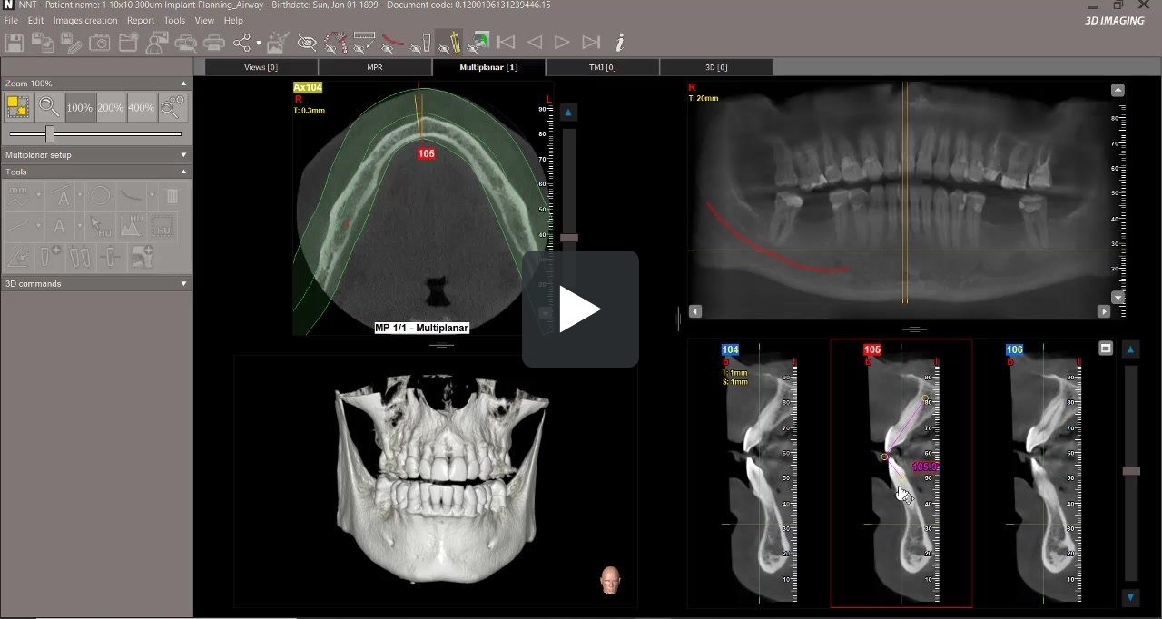 NNT 11 - Angle Tool | Cefla Medical NA
