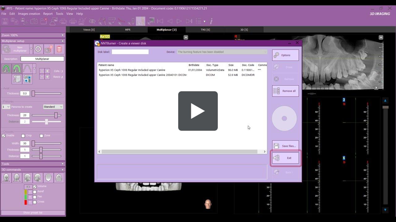 iRYS 11 - Burning a Viewer Disk | Cefla Medical NA