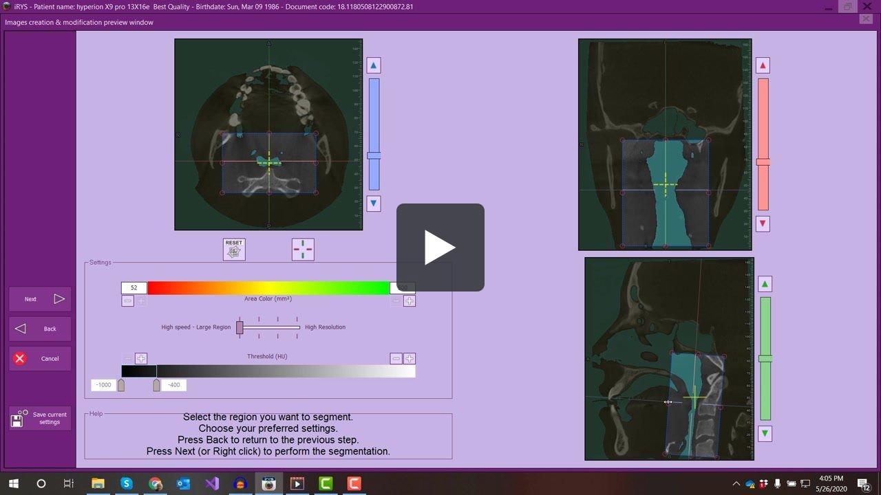 iRYs 11 - Visualizing the Airway | Cefla Medical NA